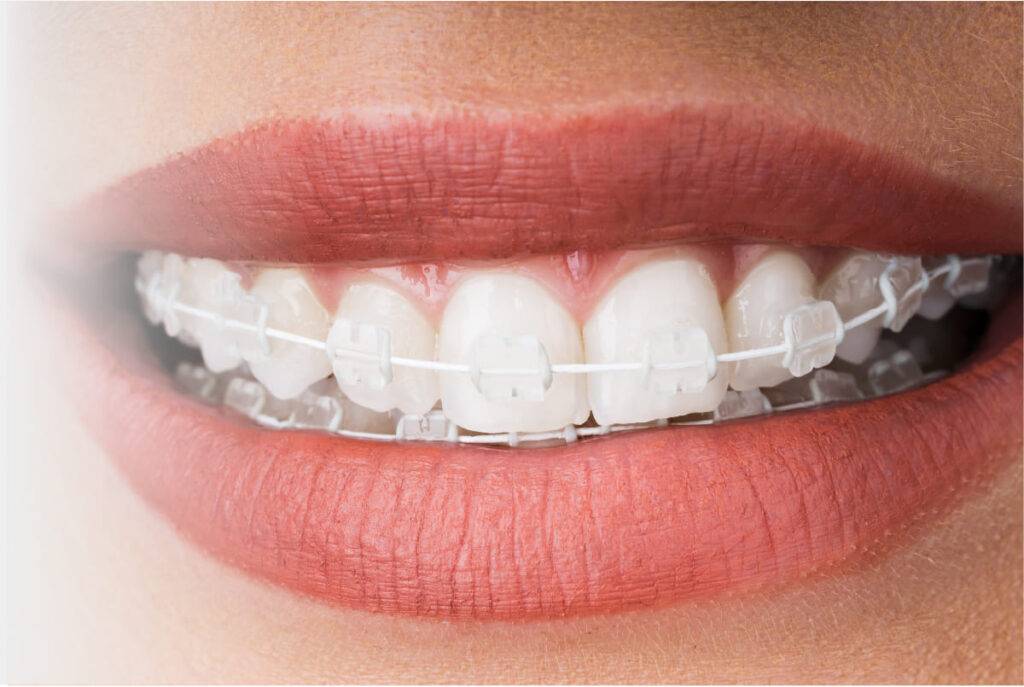 Brackets de Zafiro en Linares - Dental María José Manrique