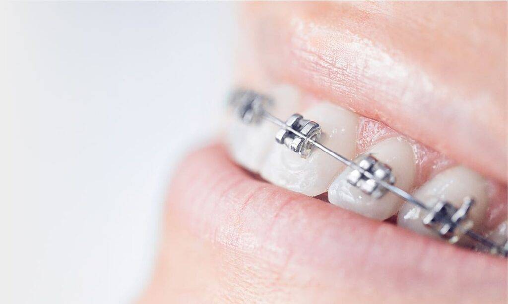 Ortodoncia con brackets Linares - Dental María José Manrique