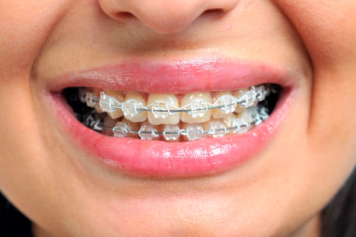 Caries Interdentales o Interproximales: Síntomas y Tratamientos